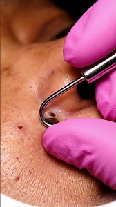 “Dermatologist-Style Acne Removal at Home!”