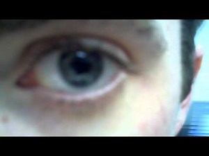 Vestibular Nystagmus