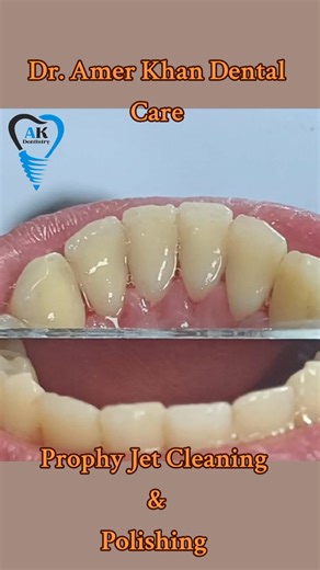 Dr. Amer Khan Dental Care in Peshawar | Prophy Jet Cleaning & Polishing