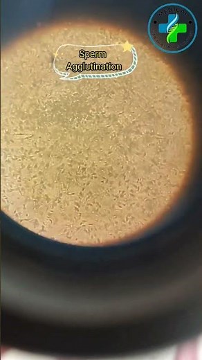 Semen analysis | sperm Agglutination | sperm under microscope | Sperm count | male fertility test