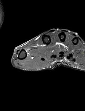 Extensor pollicis tendon longus (EPL) tendon rupture
