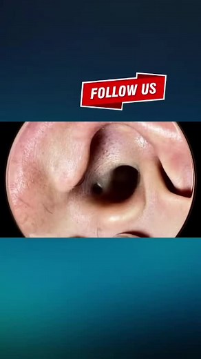 Big pimple blackhead removal #acne #pimple #blackhead #extractions #satisfying