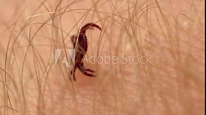 Macro Video of Encephalitis Tick Insect Crawling on Human Skin. Encephalitis Virus or Lyme Borreliosis Disease Infectious Dermacentor Tick Arachnid Parasite.