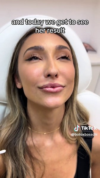 Lip Dissolving Process: Pain-Free and Worth It | Chicago Lip Filler Results