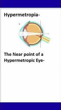 Class 10 Science Ch 10 | Myopia & Hypermetropia | Human Eye
