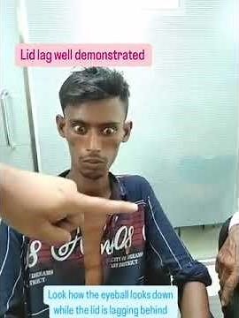 Lid lag demonstration #eyeball#lidlag#thyrotoxic#doctor#youtubeshorts#shortsfeed#ytshorts#shorts