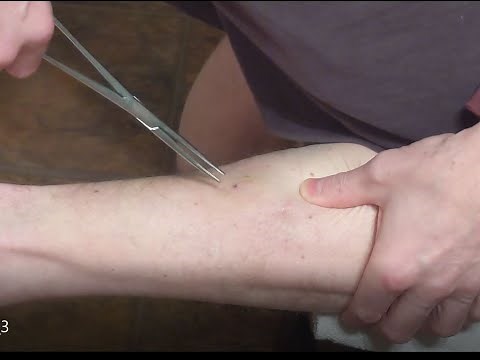 Satisfying Removal of Metal Foreign Body (Huge Metal Splinter) Using Magnet Full Video