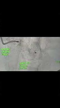 VSD Transcatheter Device Closure Step by step