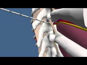 Techniques for Thoracic Paravertebral Block (TPVB)