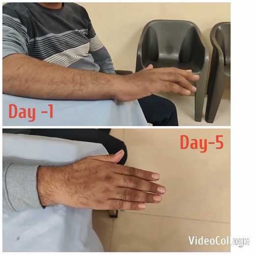 Distal radius fracture recovery shows better wrist strength and ulnar deviation in just 5 days ✨