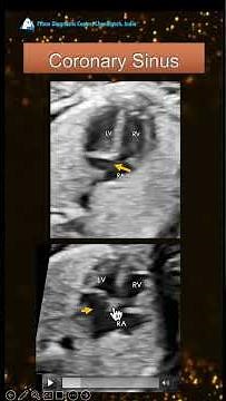 is it Primum ASD? Don’t Get Fooled on Echo!