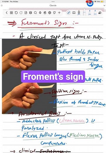 Froment’s Sign – Ulnar Nerve Palsy Explained #shorts #biology #anatomy #neet