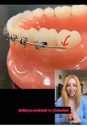Diş teli sonrası ağızda aftlar normal mi? 🤔 Bir diş hekimi olarak anlatıyorum🧚🏻‍♀️ Ortodontik braketlerin ve tellerin oluşturduğu mekanik irritasyon ve mukozal travma, aftöz lezyon gelişimini tetikleyebilir; uygun ağız hijyeni ve destekleyici bakım süreci iyileşmeyi hızlandırır 🦷✨ #ortodonti #dişteli #dişhekimi #ortodontiktedavi #teltedavisi