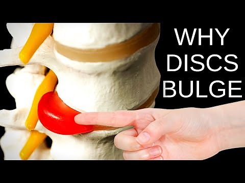 Understanding Lumbar Disc Bulges and Back Pain (Lumbar Disc Herniation, Lumbar Disc Disease)