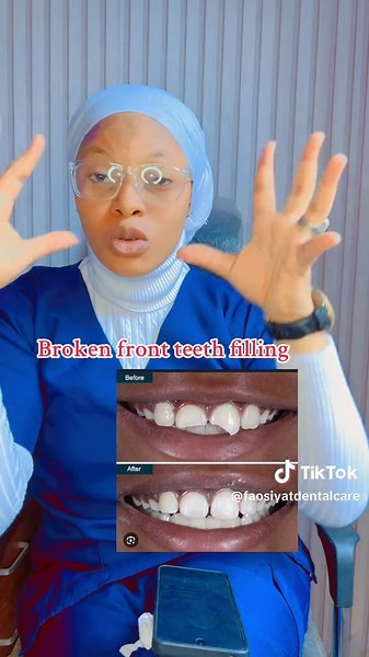 Repairing a Broken Front Tooth: What You Need to Know