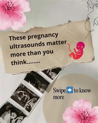 OB doctor here. In pregnancy, ultrasounds are not just photos — they are one of the most important ways we keep you and your baby safe. Each scan has a medical purpose: to check growth, placental health, baby’s anatomy, and risks we can’t see from the outside. Knowing when, why, and what each ultrasound looks for replaces fear with clarity — and helps you feel confident about your care. This reel explains the essential pregnancy ultrasounds and why they matter at different stages of pregnancy. I