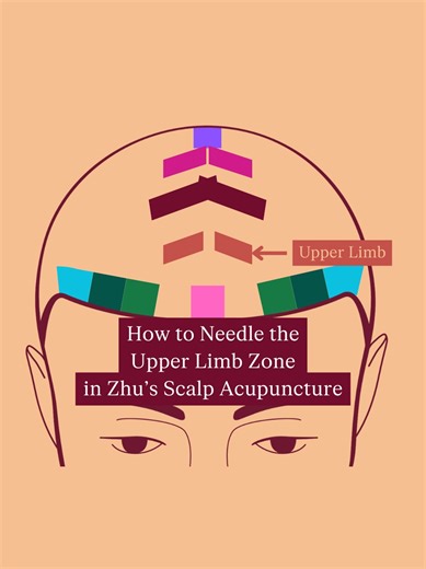 20K views · 402 reactions | Wait… ONE needle treats arm paralysis,...