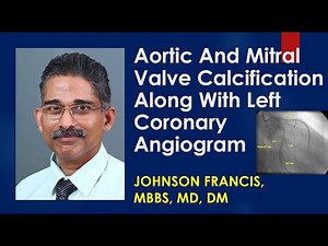 Aortic And Mitral Valve Calcification Along With Left Coronary Angiogram