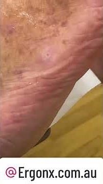 Podiatrist's Incredible Foot Surgery Relief | See the Painful Lateral Removal #Podiatry #FootCare