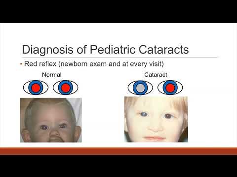 Pediatric Cataract