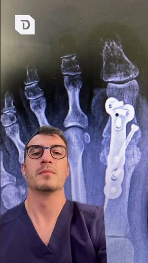 big toe fusion surgery