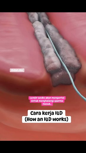 Cara kerja KB IUD (how an IUD works) Cara kerja IUD : ✅Menghambat pergerakan sperma: IUD jenis ini memiliki lilitan tembaga yang mengeluarkan zat yang membuat lingkungan rahim tidak cocok untuk sperma. Ion tembaga mengubah komposisi cairan di rahim dan leher rahim sehingga sperma tidak bisa bergerak secara efektif menuju sel telur. ✅Merusak sperma dan sel telur: Tembaga dapat merusak sel sperma dan sel telur, sehingga pembuahan tidak mungkin terjadi. #intrauterinedevice #kbiud #kb #berencanaituk