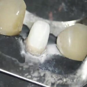 4.8K views · 236 reactions | Post & Core buildup. Credit @arta_dental_iran #Dentistry #LearningTips | Bites & Braces Dental | Facebook