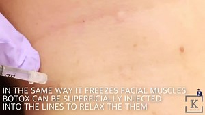 Botox for Tech Neck wrinkles