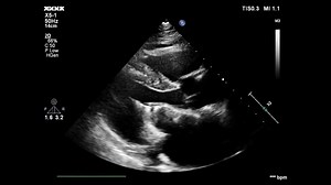 First case of spontaneous systolic anterior motion resolution - when leaflets help the operator! Learn more in #JACCCaseReports: https://bit.ly/3QdE1WQ | JACC Journals