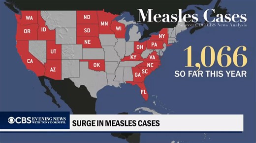 Measles cases at Ave Maria University near Naples, Florida, continue to soar, with the outbreak climbing to nearly 60 cases this week. | CBS Evening News