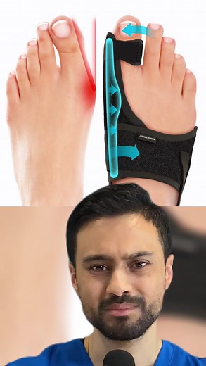 Bunion splint explained by podiatrist. #fyp #viral #bunions #podiatry #podiatrist | The Good Foot Doctor