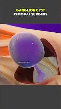Ganglion Cyst Removal Surgery | Step-by-Step Explanation #medicaleducation