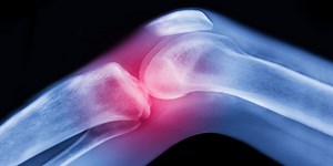 Yes, There Are Ways You Could Potentially Reduce Your Risk of Arthritis