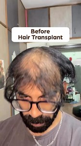 47K views · 26 reactions | Say Goodbye to Baldness with Experts You...