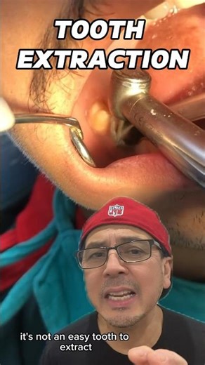 Tooth Extraction on Molar with SEVERE Tooth Decay | In Office to Hands On Dental Training #shorts