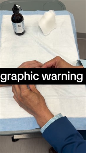 Dr. Dzi-Viet Nguyen | This patient came in with a dislocated PIP in the small finger. With local anesthetics we were able to numb her finger and reduce the... | Instagram