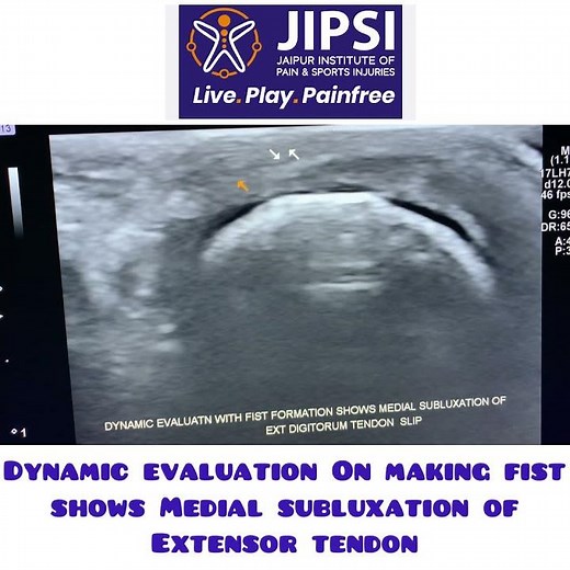 Ultrasound of Extensor tendon finger injury /Dorsal hood injury
