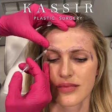Botox Injections from low eyebrows (lifting them up ) by Dr. Kassir