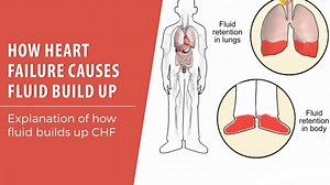 How Heart failure causes fluid build up