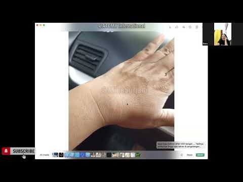 Testimony HemoHIM - Tumor Jinak / Kista Ganglion | Dora 🇮🇩