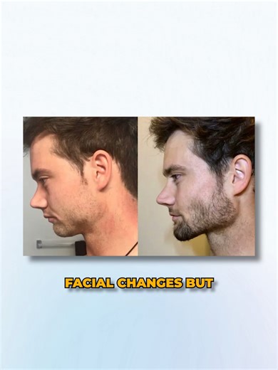 Mewing Techniques for Adults Over 25