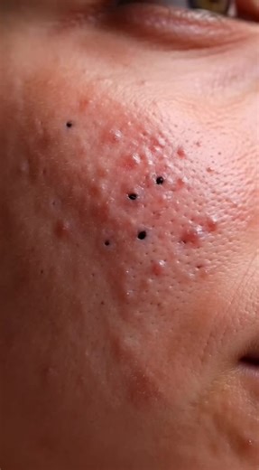 Blackhead Extractor Tips for Satisfying Results