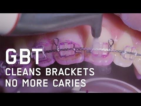Brackets with GBT - Guided Biofilm Therapy