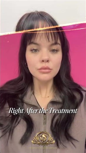 Here's What Masseter Botox Looks Like Before and After