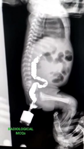 Barium enema study under fluoroscopy #olddelhi #education #radiology #radiologylife #aiims #aiimsdelhi #xray #radiologictechnologist #radiologist | Radiological MCQS