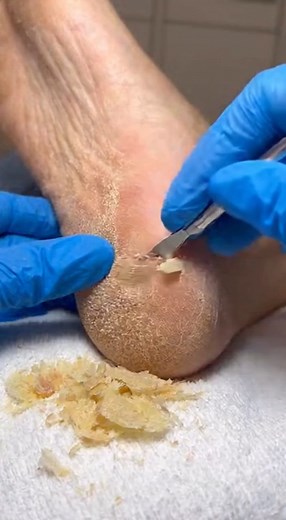 116K views · 175 reactions | ASMR SATIFYING DEAD OLD SKIN AND CALLUS REMOVAL FOOTPEEL THE BEST (26) | Esk Printing-អេងសុគន្ធាបោះពុម្ព | Facebook