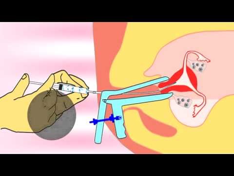 Intrauterine insemination (IUI), IUTPI, the new method of insemination video