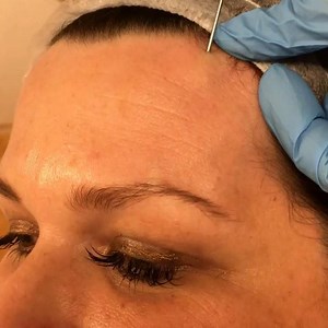 EYE BROW LIFT USING PDO THREADS 👀 . Aim of the treatment is to lift the middle and lateral ends of the brow, giving a natural pull to open up the eye. . 💉PDO Cogs are used by injecting local anaesthetic into the area and inserting the cannula under the muscle . ✂️The threads are then pulled, twisted and cut to create a natural lift . 😳Result is immediately and gets better over 12 weeks as collagen starts to produce. . 🤔The thread then breaks down, leaving your natural collagen behind. . 💰 C