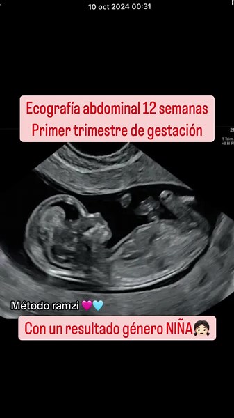 Método Ramzi para la Revelación de Género del Bebé