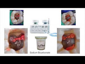 WaveOne® Gold single file use with Dr. Peet Van ver Vyver | Dentsply Sirona